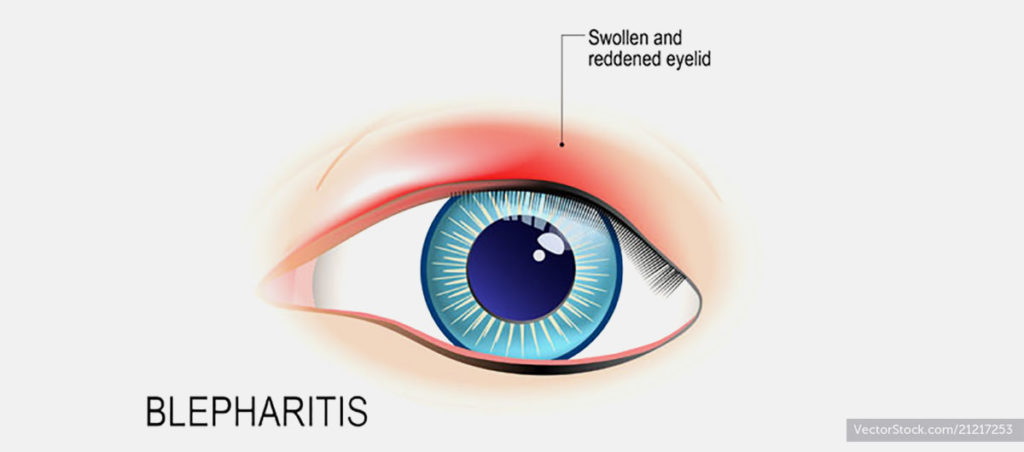 Blepharitis - Al Manal Eye Hospital
